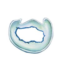 Meniscus Injuries | Medial Meniscus Tear | Meniscus Tear Types ...