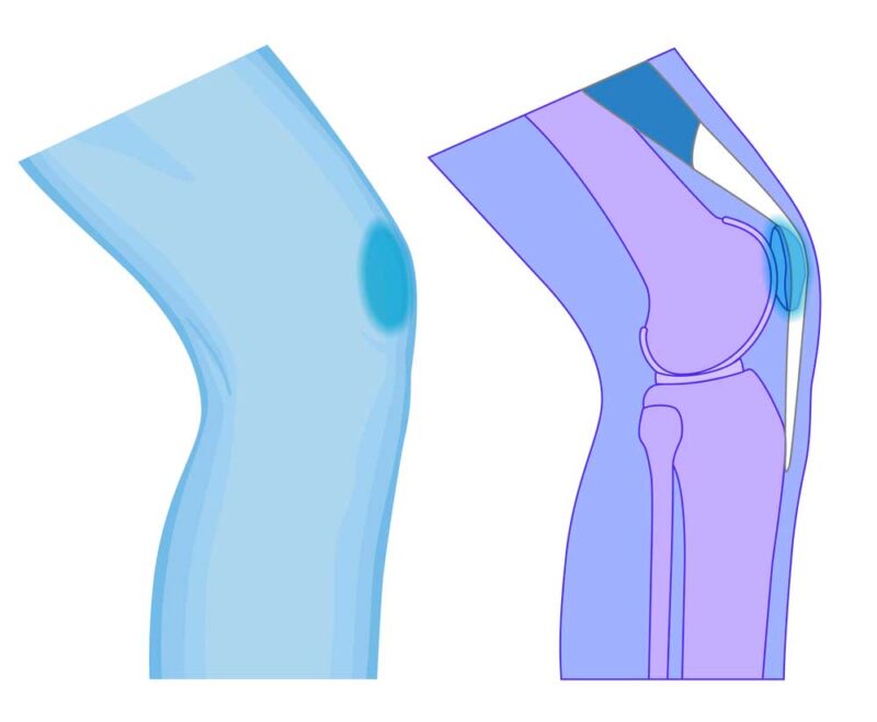 Patellofemoral Overload Syndrome | Patellofemoral Cartilage Injury ...