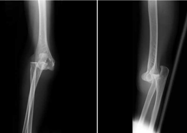 Elbow Dislocation | Posterolateral Elbow Instability | Dislocated Elbow ...