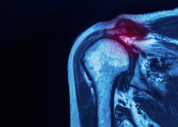 Shoulder Labrum Repair | Labral Reconstruction | Orthopedic Shoulder ...